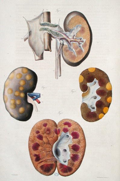 Nyresygdomme, fra 'Anatomie Pathologique du Corps Humain' af Jean ...